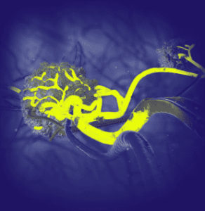 About Lipiodol – Guerbet Lipiodol